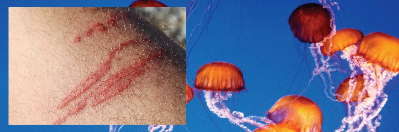 First Aid Afloat - Jellyfish Stings - Safe Skipper Boating & Safety ...